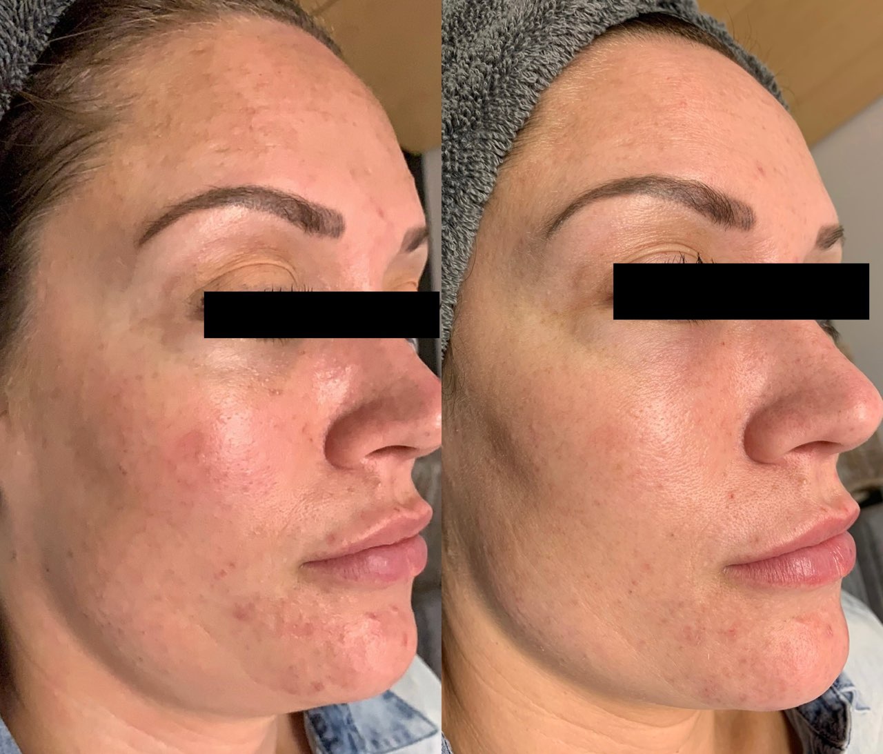 CUTERA Laser Genesis - Perfect Skin Las Vegas