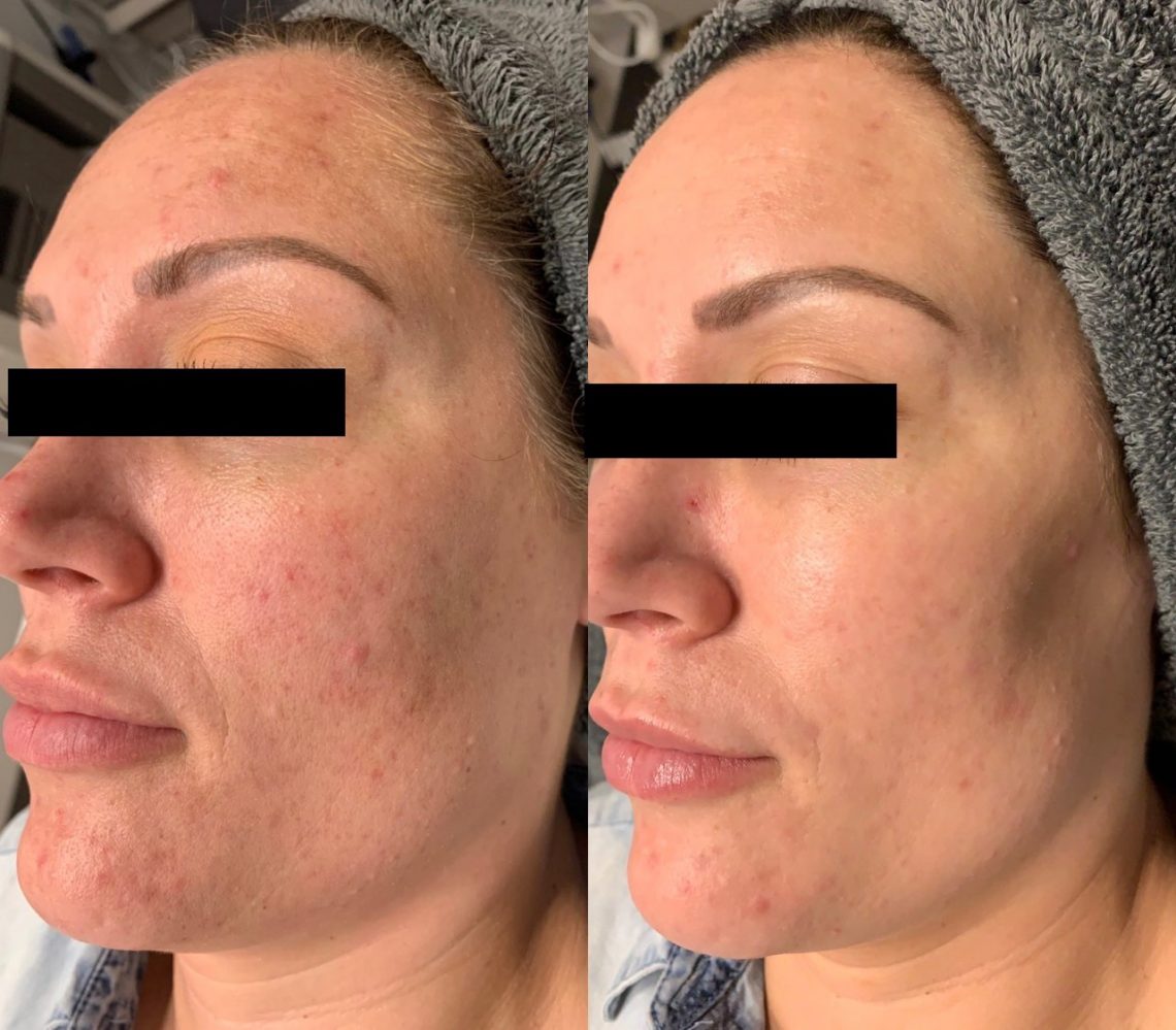 CUTERA Laser Genesis - Perfect Skin Las Vegas